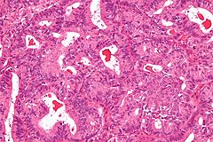 Adenocarcinoma of the rete testis - Libre Pathology
