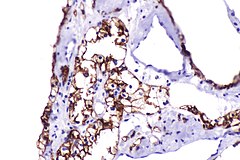 Carbonic anhydrase 9 - Libre Pathology