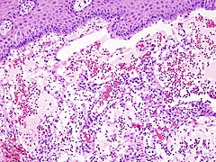 Salivary gland mucocele - Libre Pathology