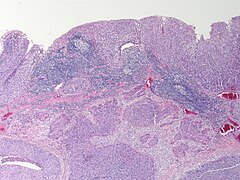 Squamous cell carcinoma - Libre Pathology