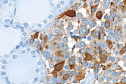 C-cell hyperplasia - Libre Pathology
