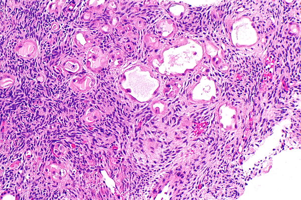 Mixed epithelial and stromal tumour of the kidney - Libre Pathology