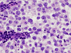 Seminoma - Libre Pathology