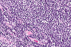 Follicular lymphoma - Libre Pathology