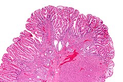 Peutz-Jeghers polyp - Libre Pathology