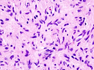 Plexiform Neurofibroma Histopathology