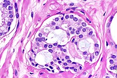 Mucinous fibroplasia - Libre Pathology
