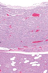 Neuroendocrine tumour of the pancreas - Libre Pathology