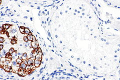 Germ cell neoplasia in situ - Libre Pathology