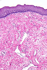 Oral fibroma - Libre Pathology