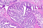 Intraductal carcinoma of the prostate - Libre Pathology
