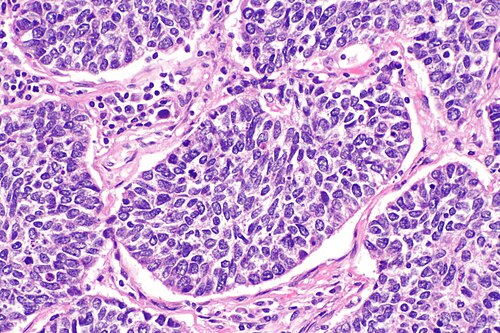 lung cancer histology quiz