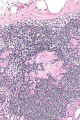Lymph node pathology - Libre Pathology