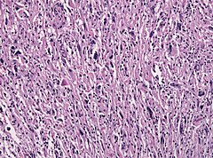 High-grade astrocytoma with piloid features - Libre Pathology