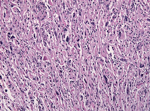 Anaplastic pilocytic astrocytoma - Libre Pathology