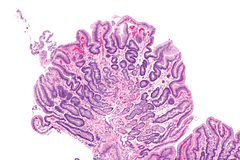 Reactive gastropathy - Libre Pathology